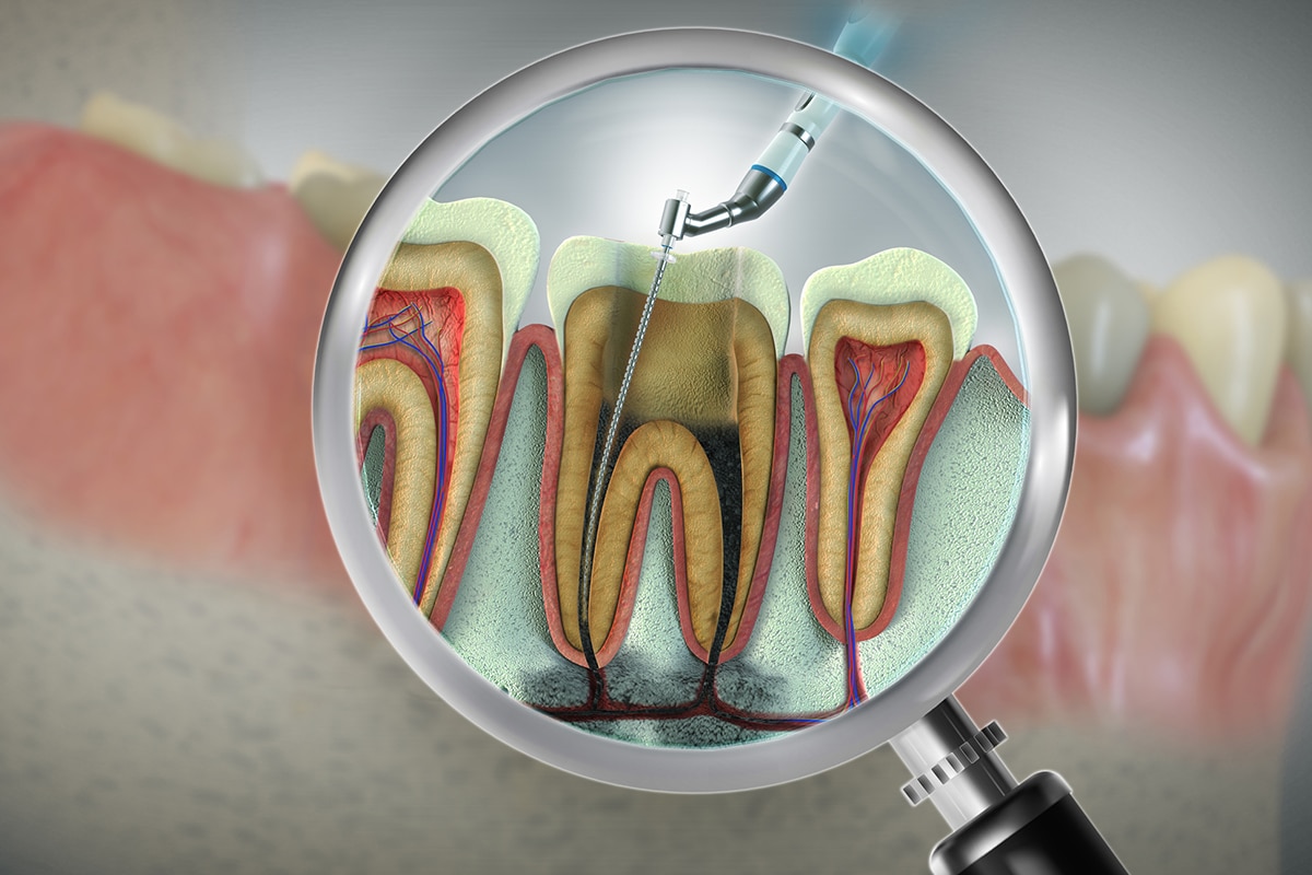 Understanding Root Canal Retreatment: Why It May Be Necessary After Years - Advanced Endodontics